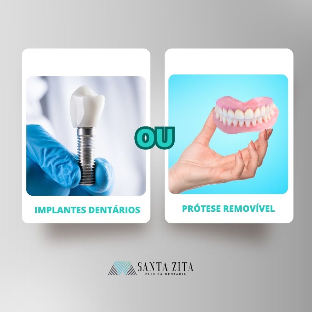 Próteses Removíveis ou Implantes Dentários: Qual a Melhor Opção para ...